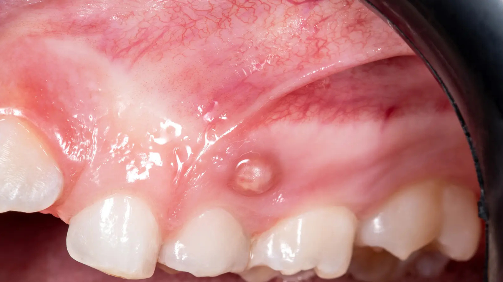 Can Popping a Gum Abscess Kill You?